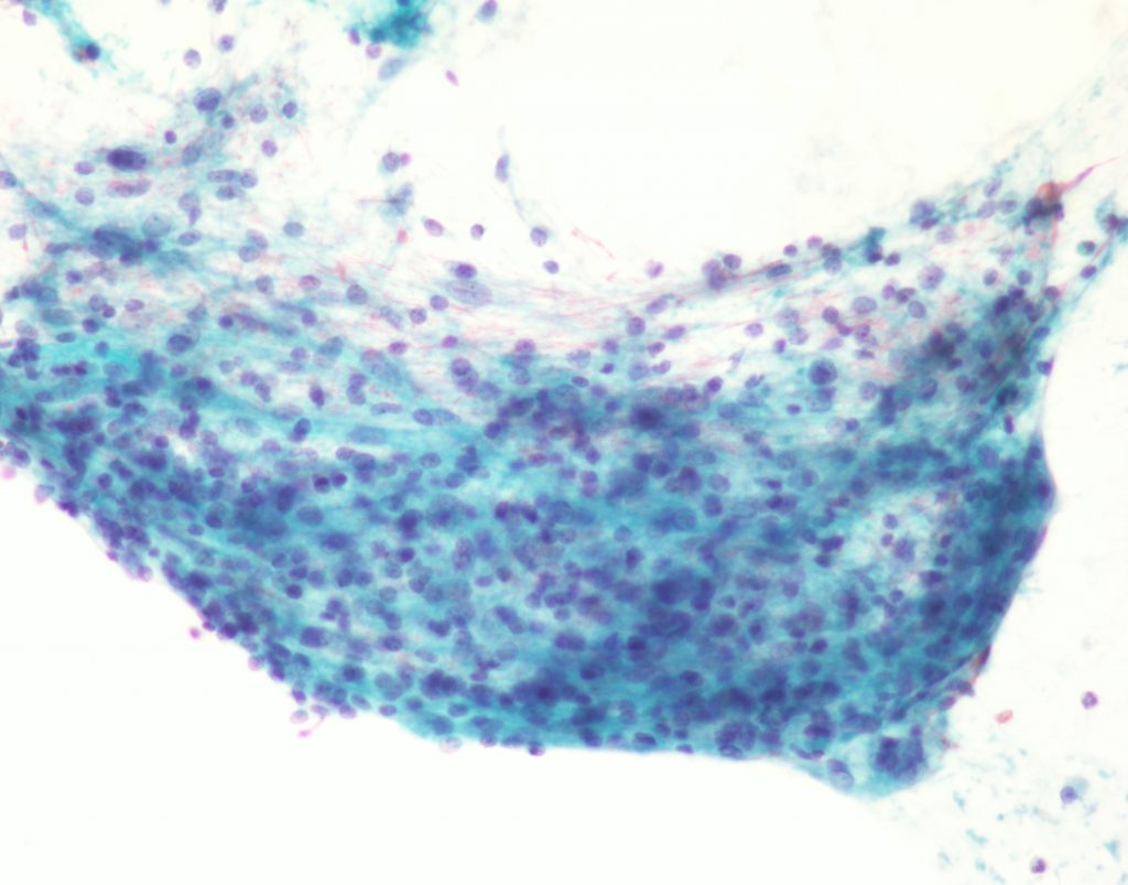 Case 31 | Johns Hopkins Cytopathology Unknown Conference
