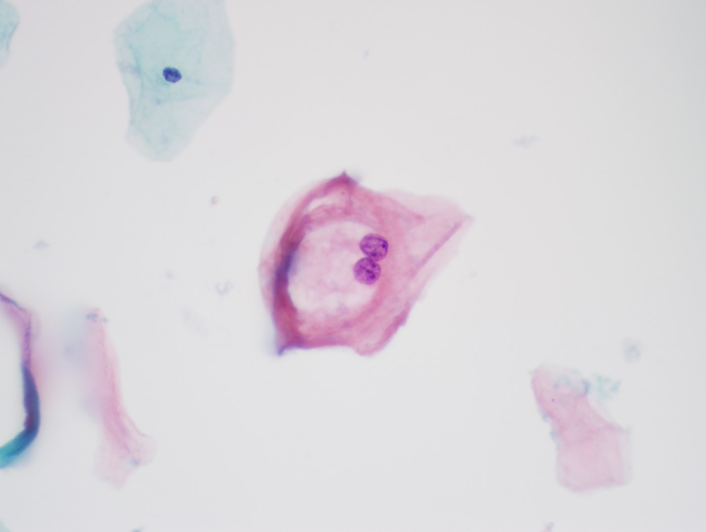 Case 38 | Johns Hopkins Cytopathology Unknown Conference